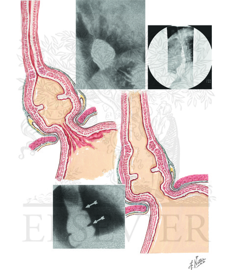 esophagus constriction ring