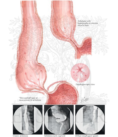 diffuse esopahgeal spasm