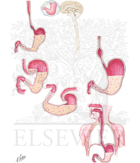 Aerophagia and Belching