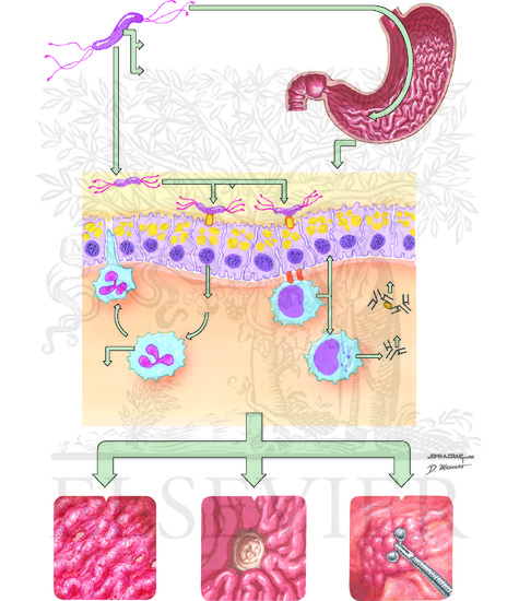 Helicobacter Pylori infection: Etiology and Pathogenesis of ...