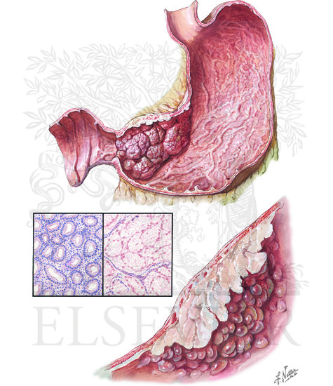 Carcinoma of Stomach: Adenocarcinoma of Stomach
