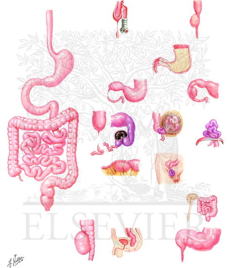 Overview of Digestive Tract Obstructions