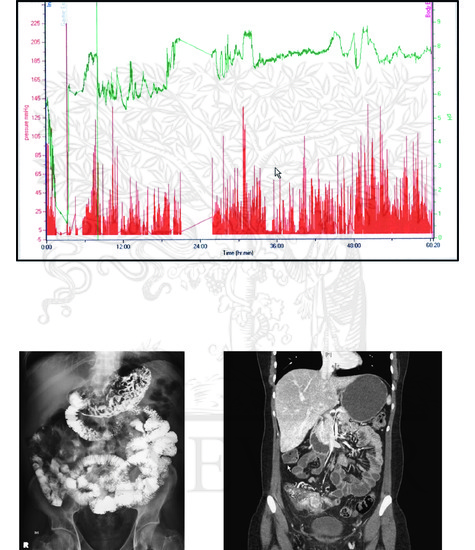 Tests for Small-Bowel Function: Wireless Motility Capsule