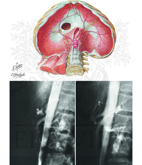 celiac artery compression