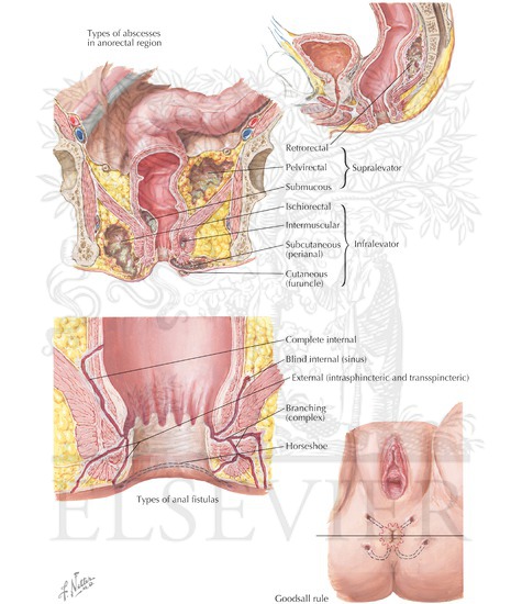 pelvirectal abscess