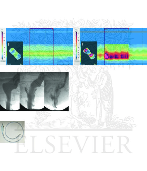Motility Testing: 3D High Resolution Anorectal Manometry with Balloon ...