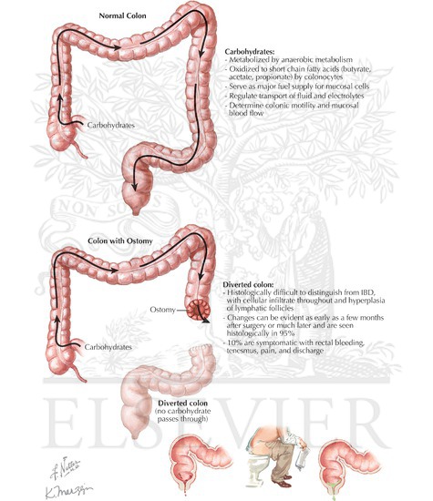 Diversion colitis