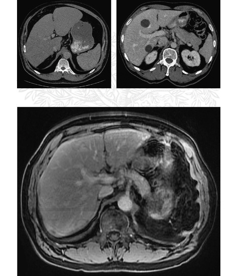 Imaging Studies of the Liver (CONTINUED): Computed Tomography and ...