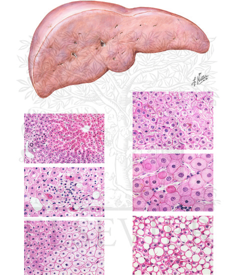 Pathologic Features of Liver Injury