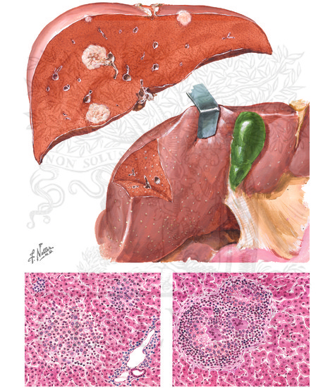 Granulomatous Liver Disease: Tuberculosis