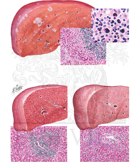Hematologic Malignancy and the Liver: Hodgkin’s Disease, Leukemia ...