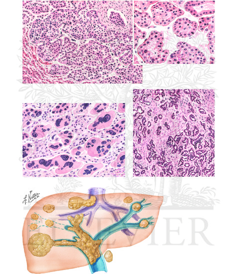Hepatocellular Carcinoma Continued Histologic Features And Spread