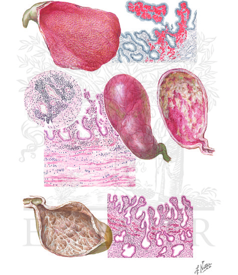 Cholecystitis: Acute and Chronic