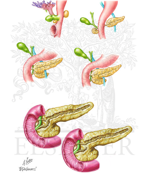 Congenital Anomalies of Pancreas