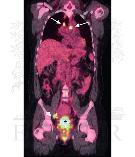 A coronal fused image of 2-18F-deoxyglucose-based positron emission tomography (PET) and ...