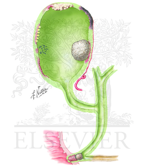 Interrelation of Gallbladder Diseases