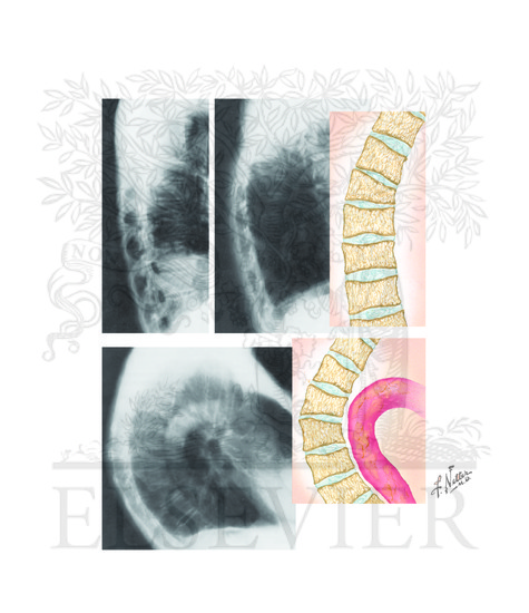 Radiographic Findings in Osteoporosis