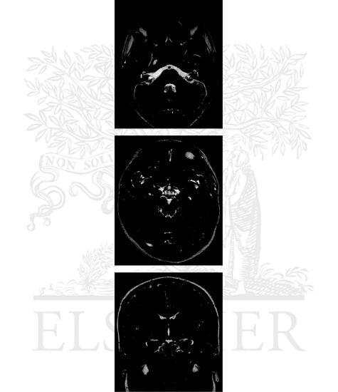 Axial and Coronal MRIs of Brain