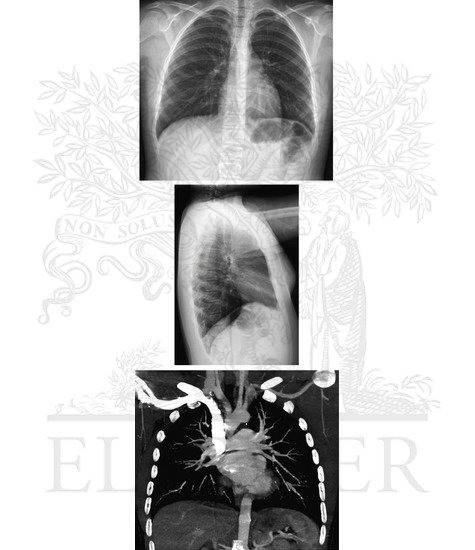 Heart: Radiographs and CT Angiogram