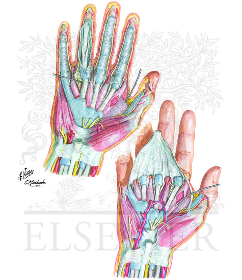 Wrist and Hand: Deeper Palmar Dissections