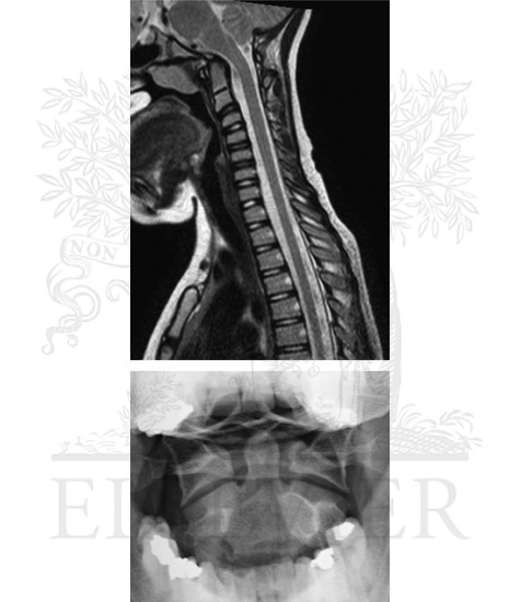 Cervical Spine MRI and Radiograph