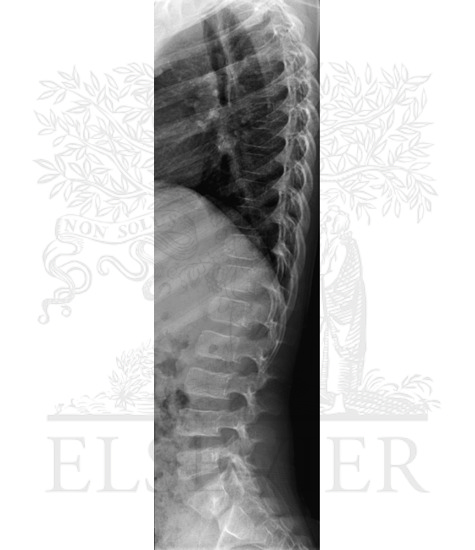Thoracolumbar Spine - Lateral Radiograph