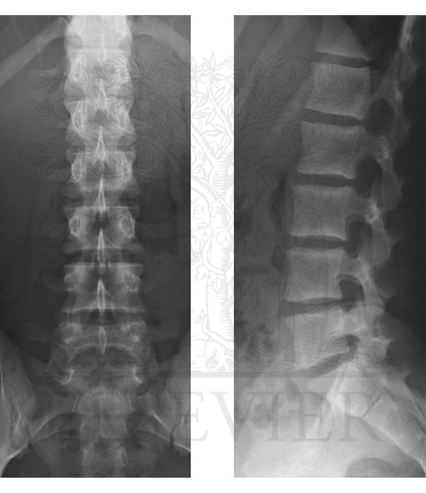 Lumbar Vertebrae: Radiographs