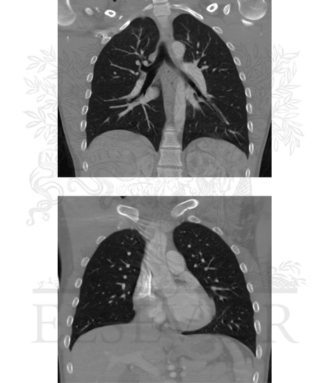 Thorax - Coronal CTs