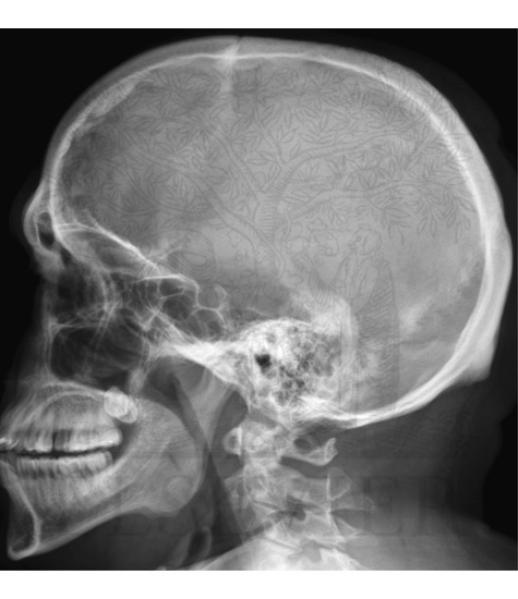 Skull: Lateral Radiograph Skull: Lateral Radiograph