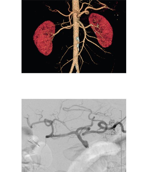 Celiac Trunk Angiogram Anatomy