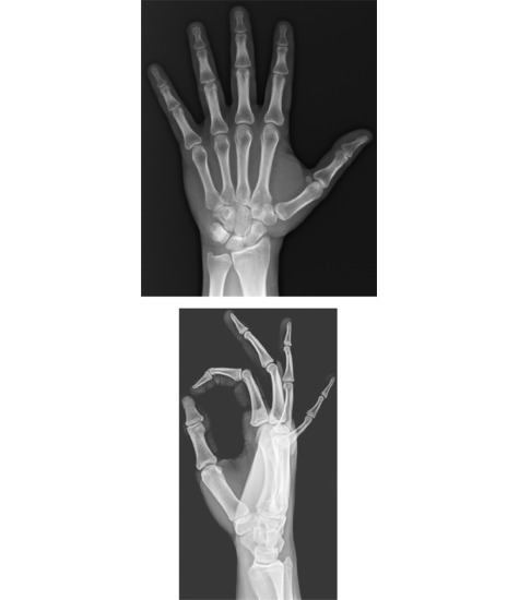 Wrist and Hand: Radiographs