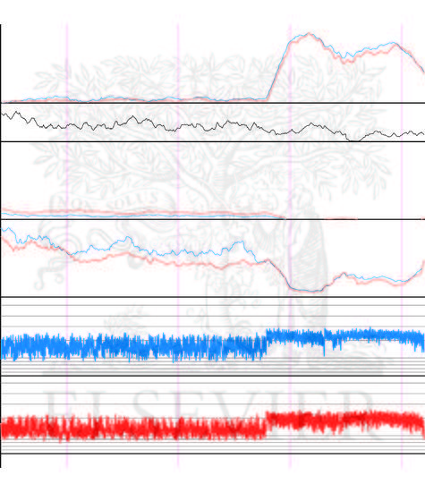 Quantitative Electroencephalography Time Lapsed Over 45 Minutes