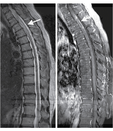 spinal thoracic mri