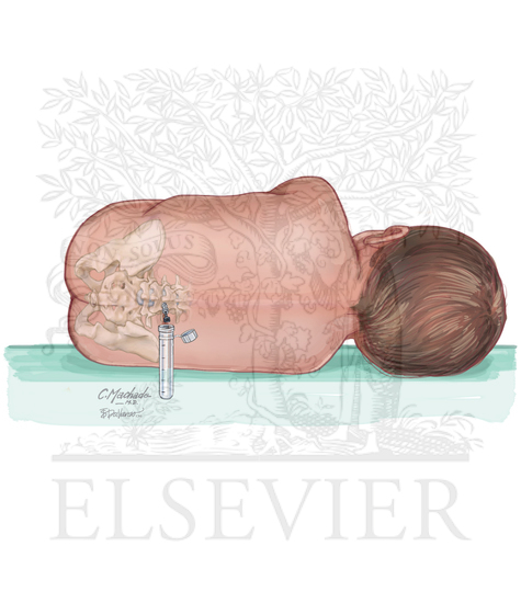 lumbar puncture baby position