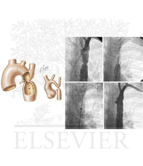 Stepwise Stent Implantation for Coarctation of the Aorta