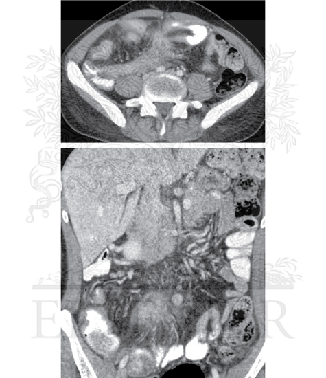 Radiographic Findings: Crohn Disease