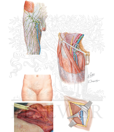 Inguinal lymph node dissection Inguinal lymph node dissection