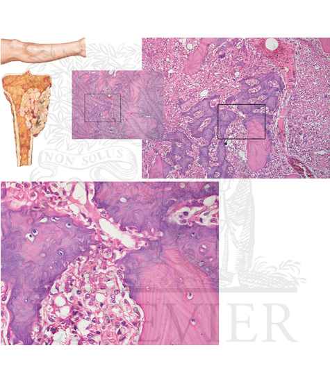 Pathology of Bone
