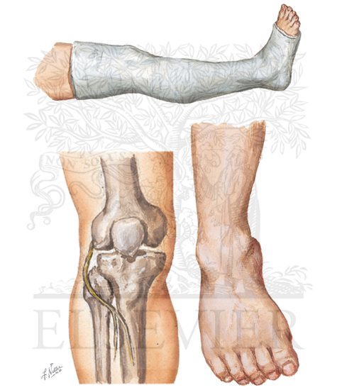 peroneal nerve compression