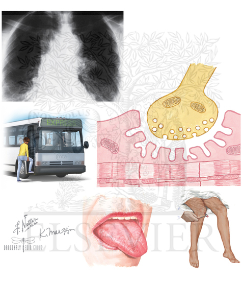 Presynaptic Neuromuscular Junction Transmission Disorders: Lambert ...