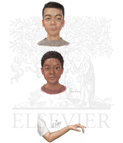 Congenital Myasthenic Syndromes