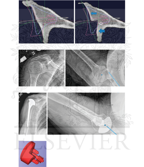 Osteoarthritis of the Glenohumeral Joint (Continued)