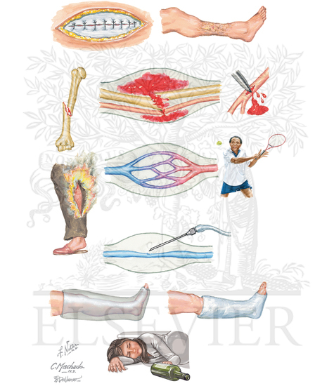 Etiology of Compartment Syndrome
