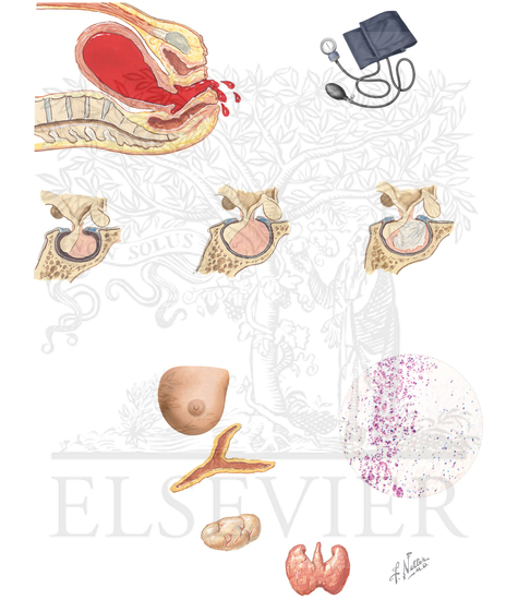 Postpartum Pituitary Infarction (Sheehan’s Syndrome)