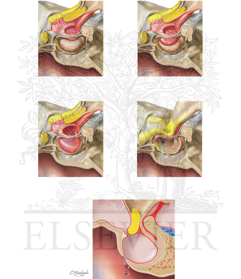 Empty Sella Turcica Diagram