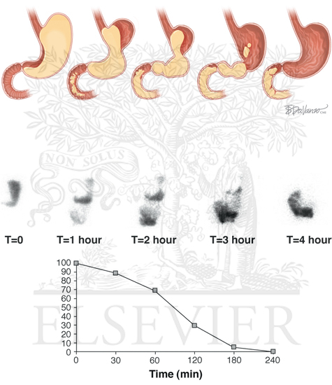 Diagnostic Tests in Gastric Disorders: Gastric Emptying Scintigraphy