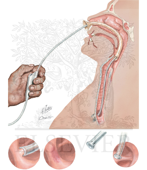 endotracheal suctioning