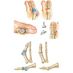 Surgical Procedures for Toe Deformities