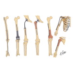 Limb-Salvage Procedures for Reconstruction of Joint After Resection for ...