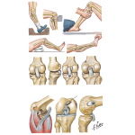 Rupture of Posterior Cruciate Ligament